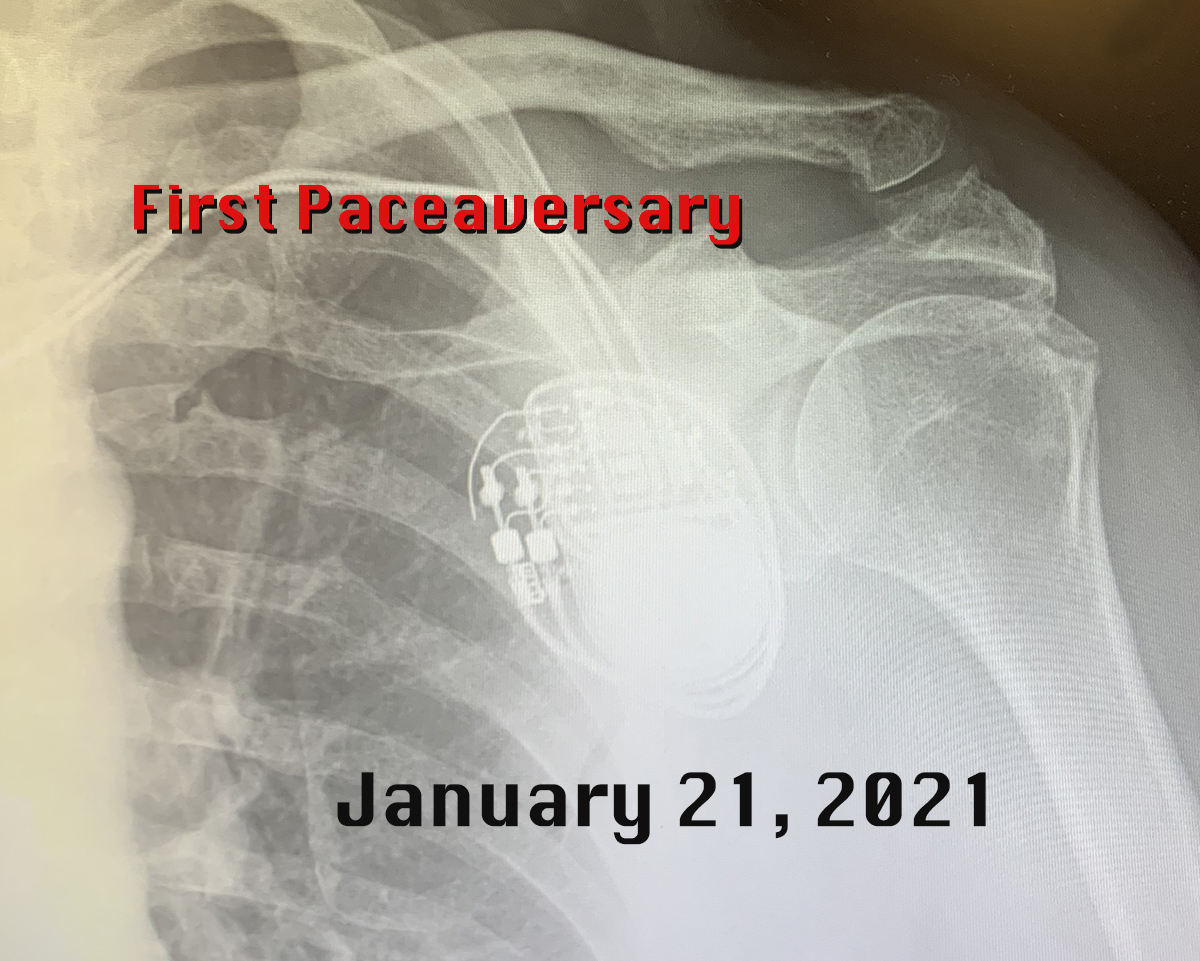 My Pacemaker 1st Anniversary! My Covid Vaccine Anniversary! - Lambert ...